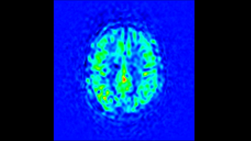 PCASL - Siemens Healthineers