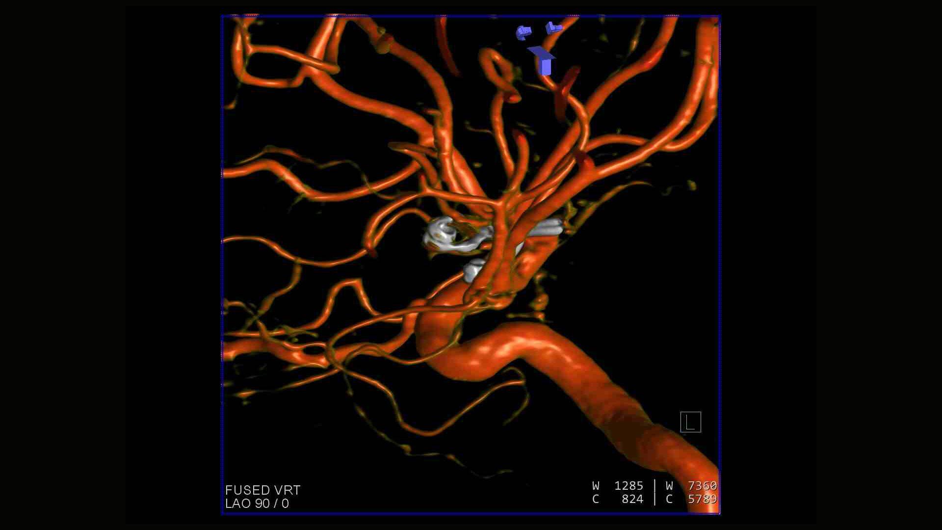 Neurosurgery - Siemens Healthineers