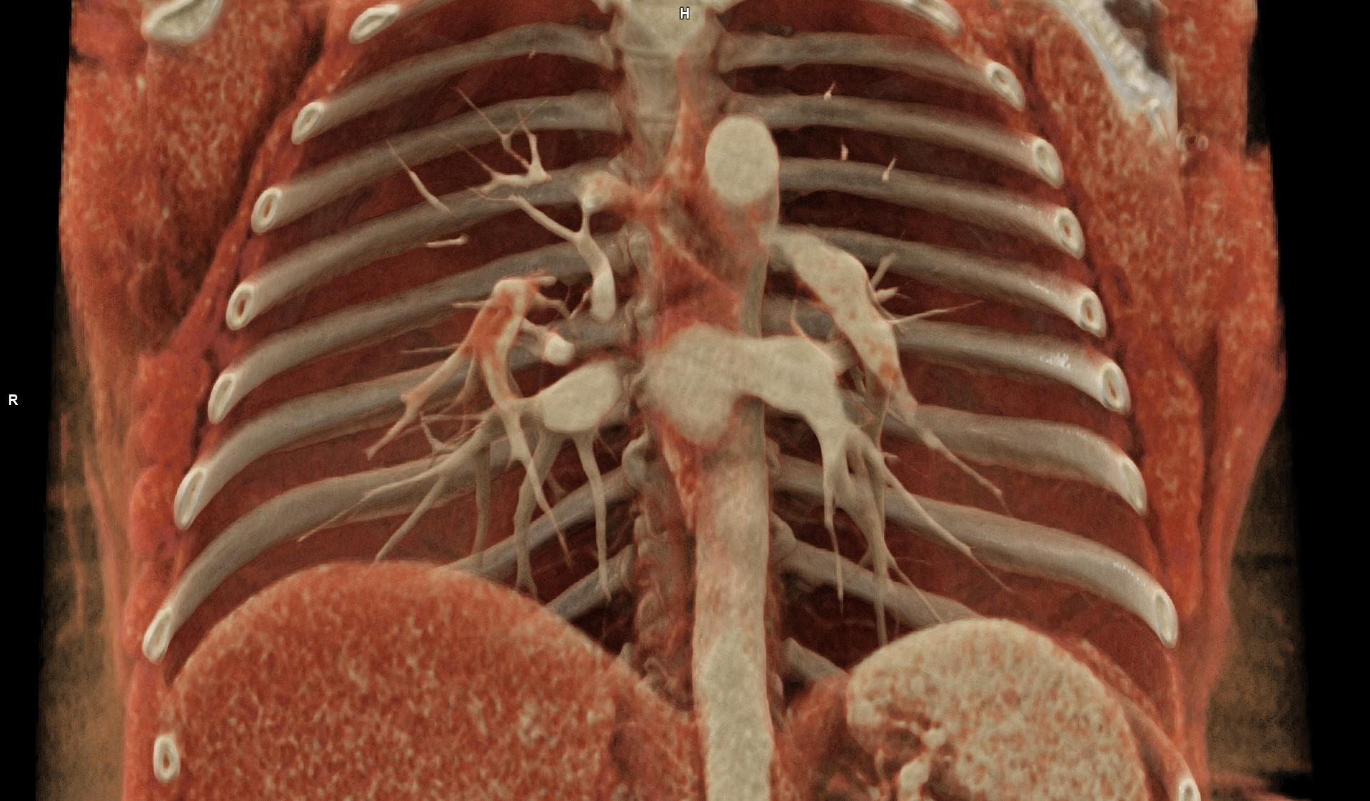 Detección de embolia pulmonar incidental en un paciente obeso - Siemens ...