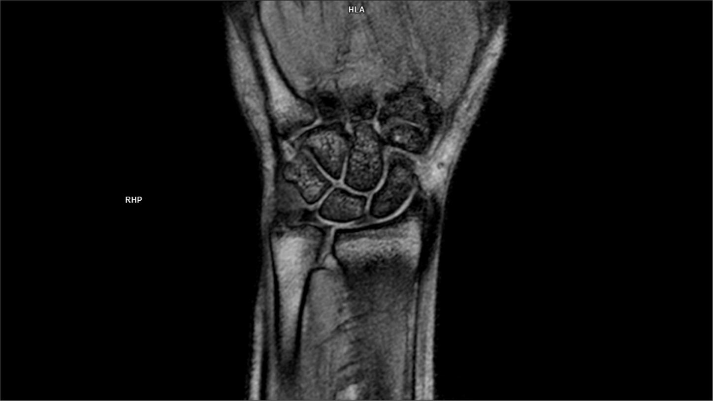 Coronal 3D GRE-MAGNETOM Free.Max - Siemens Healthineers USA