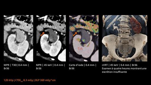 NAEOTOM Alpha : applications oncologiques - Siemens Healthineers France