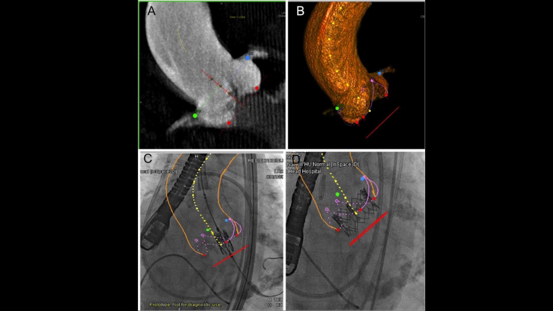 Structural Heart Disease - Siemens Healthineers