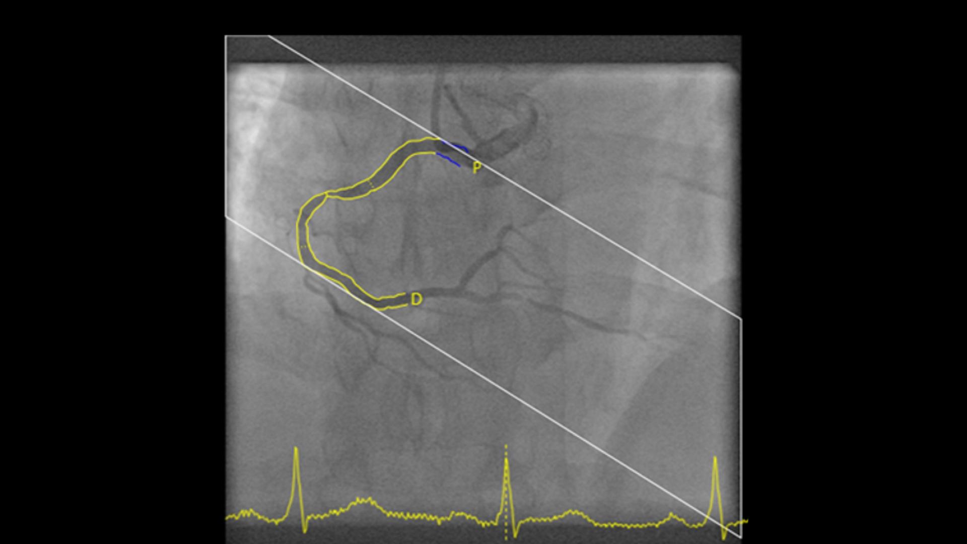 Rethink FFR assessment for every patient - Siemens Healthineers