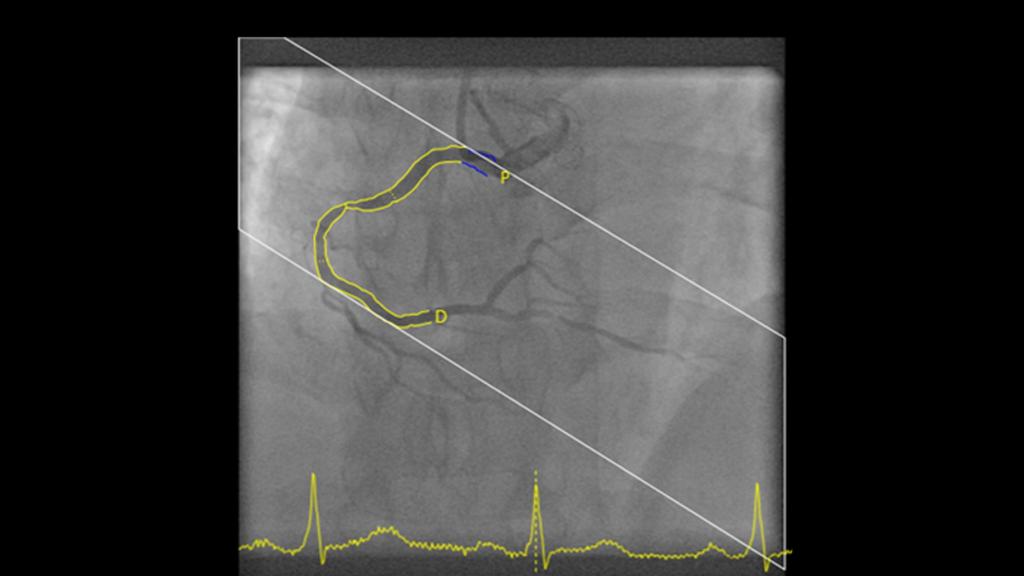 Rethink FFR assessment for every patient - Siemens Healthineers