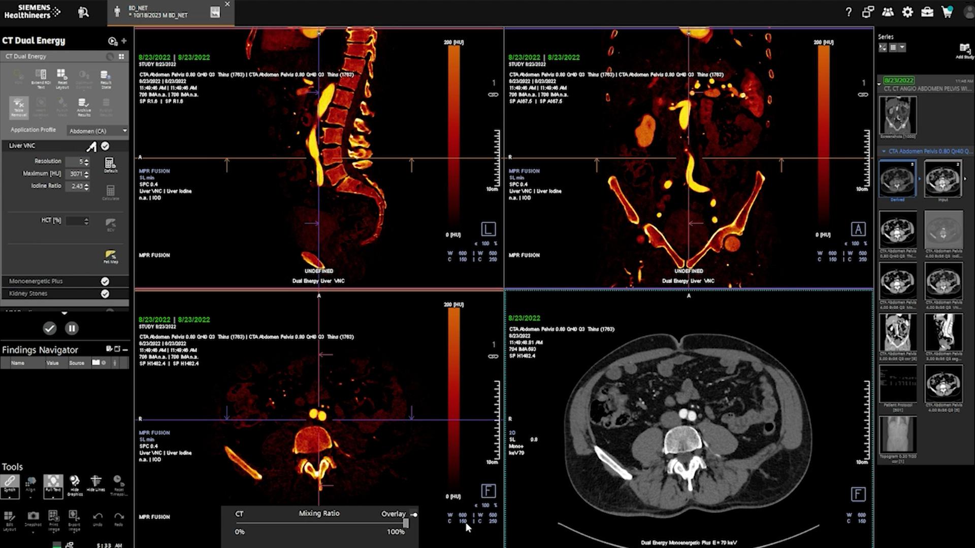 Implementing photon-counting CT in pancreatic cancer imaging: Practical tips and clinical ...