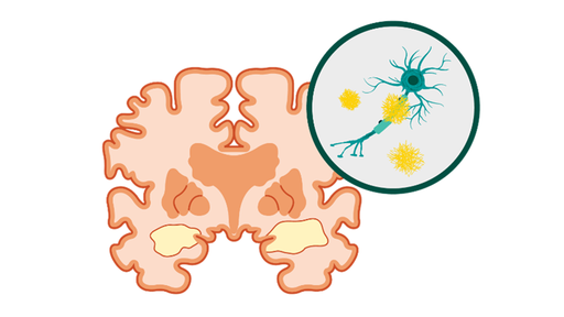 Beta-amyloid PET/CT imaging for Alzheimer's disease - Siemens ...