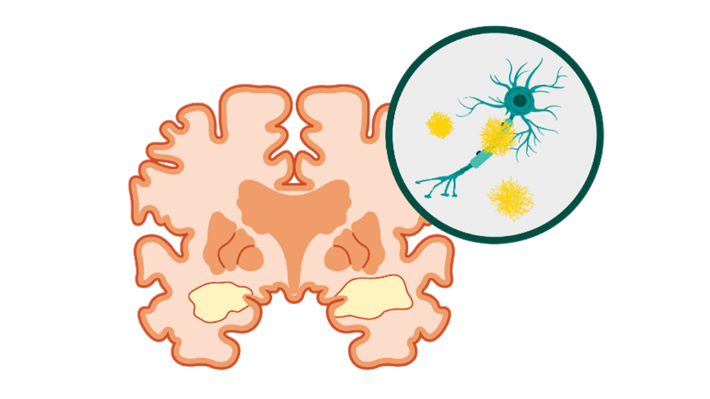 Beta-amyloid PET/CT imaging for Alzheimer's disease - Siemens ...