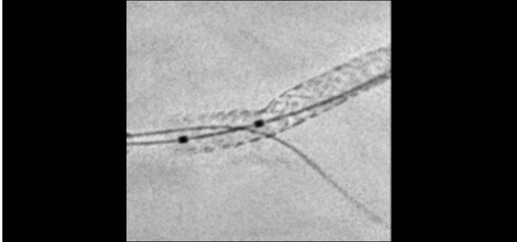 Enhanced stent visualization assists in improving the outcome of ...