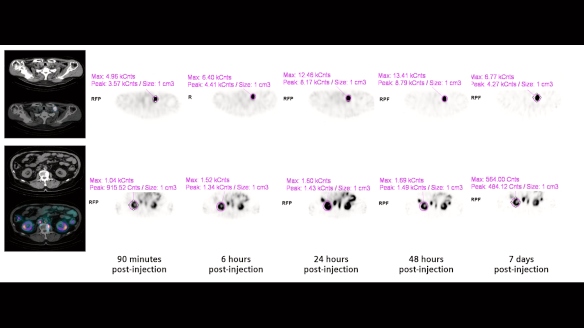 Tumor and organ dosimetry from sequential quantitative SPECT/CT ...