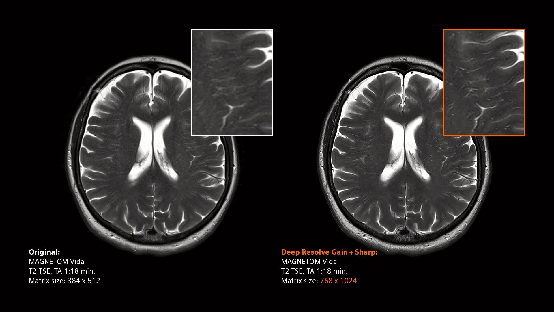 Deep Resolve - Siemens Healthineers France