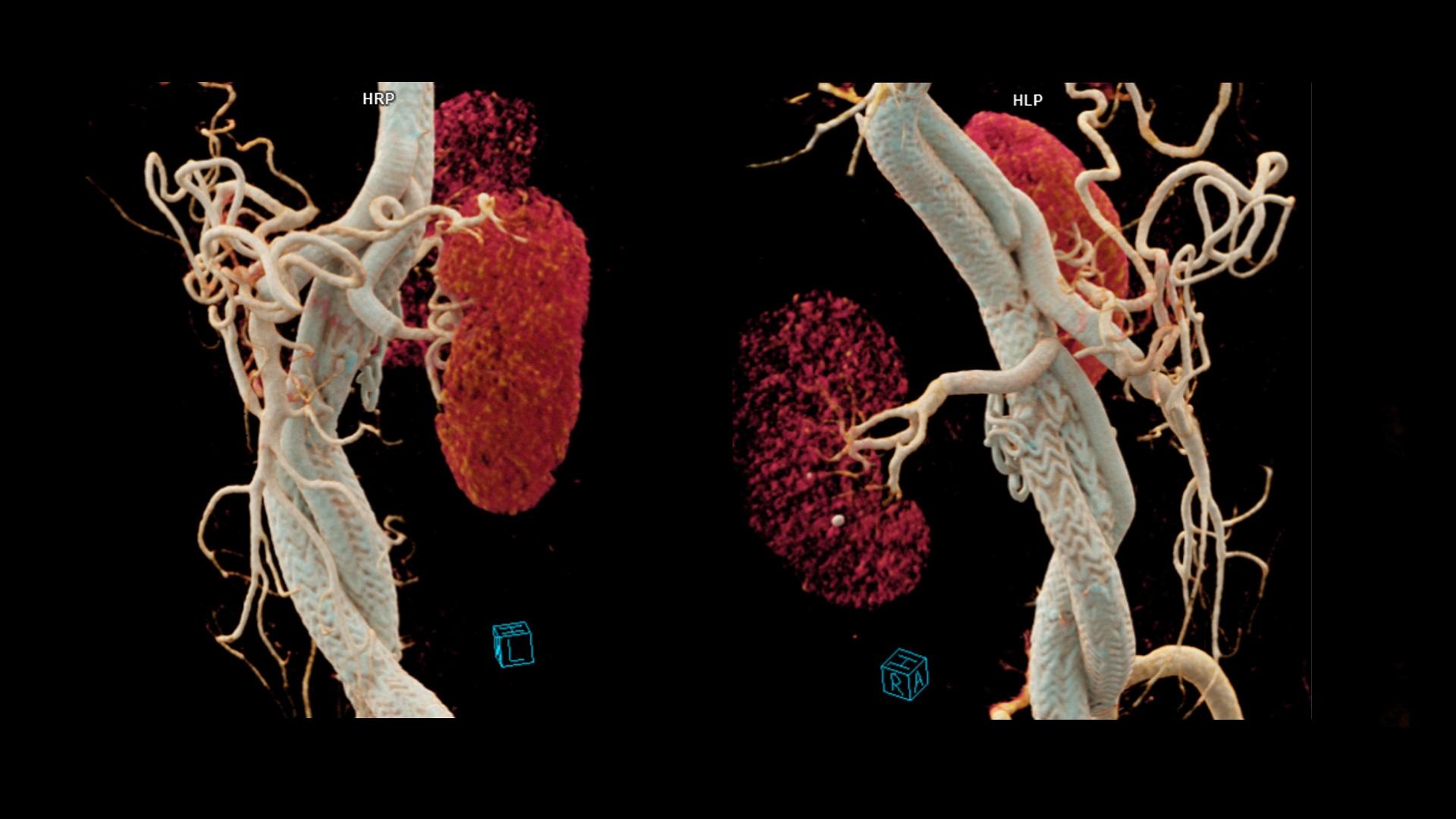 Complex thoracoabdominal aortic aneurysm – EVAR with renovisceral ...
