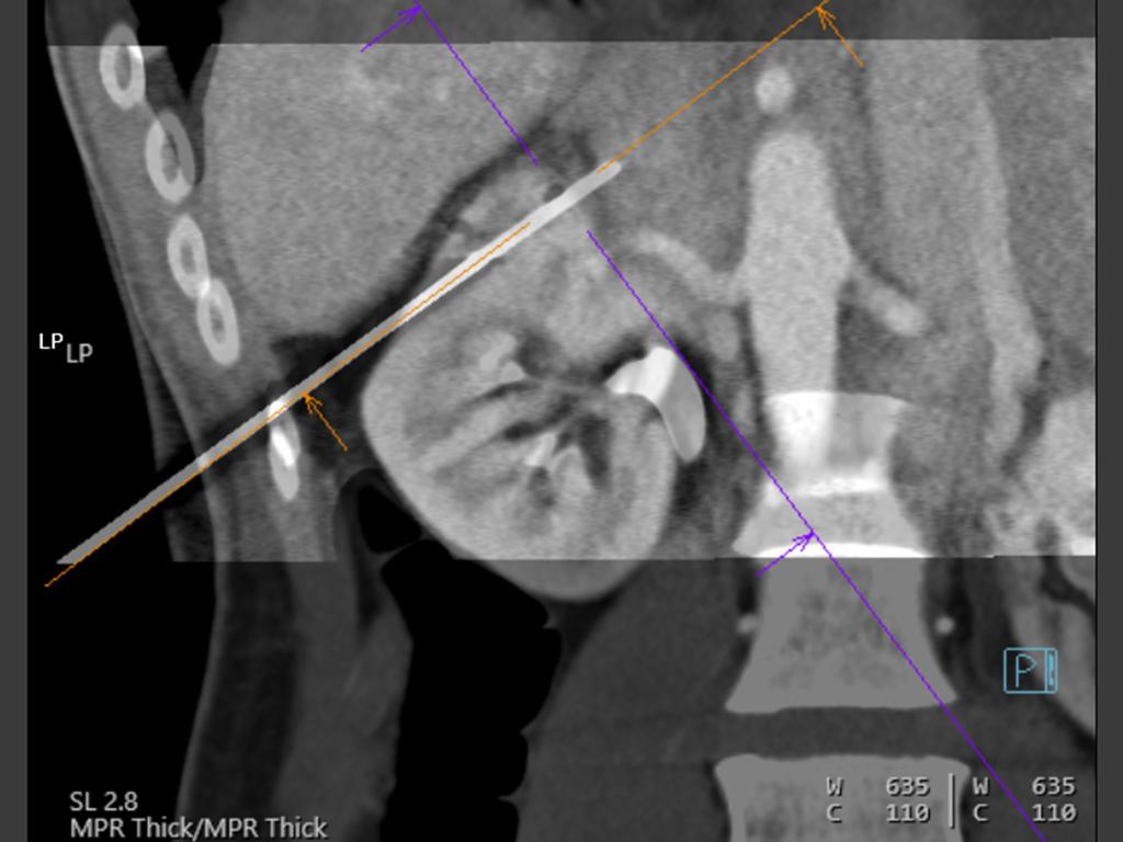 NAEOTOM Alpha photon-counting CT scanner - Siemens Healthineers