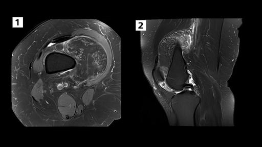 Lesiones tumorales expansivas en rodilla - Siemens Healthineers ...