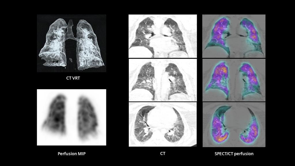 Symbia Pro.specta SPECT/CT - Siemens Healthineers