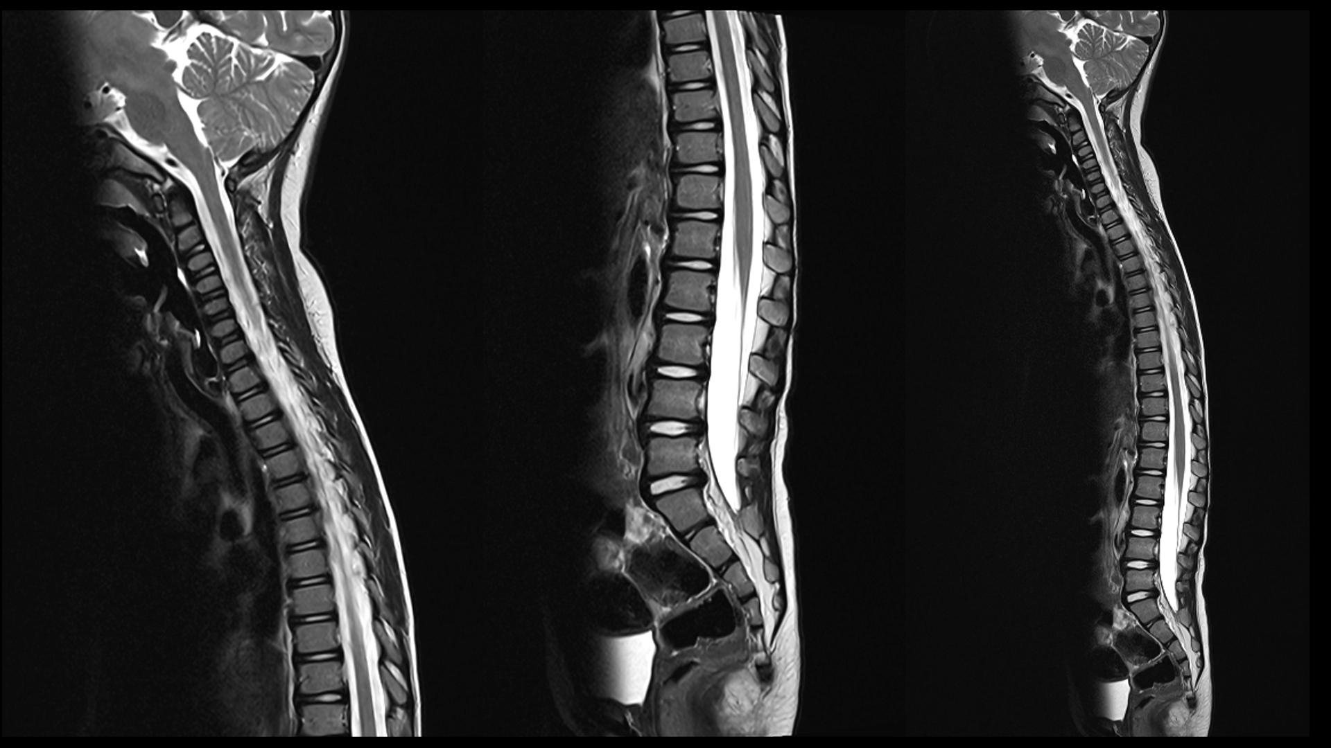 Pediatric protocols using Deep Resolve