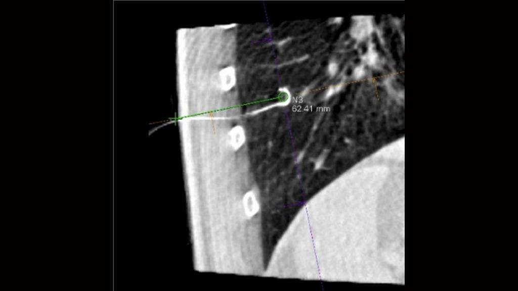 Diagnosis And Treatment Of Lung Cancer - Siemens Healthineers