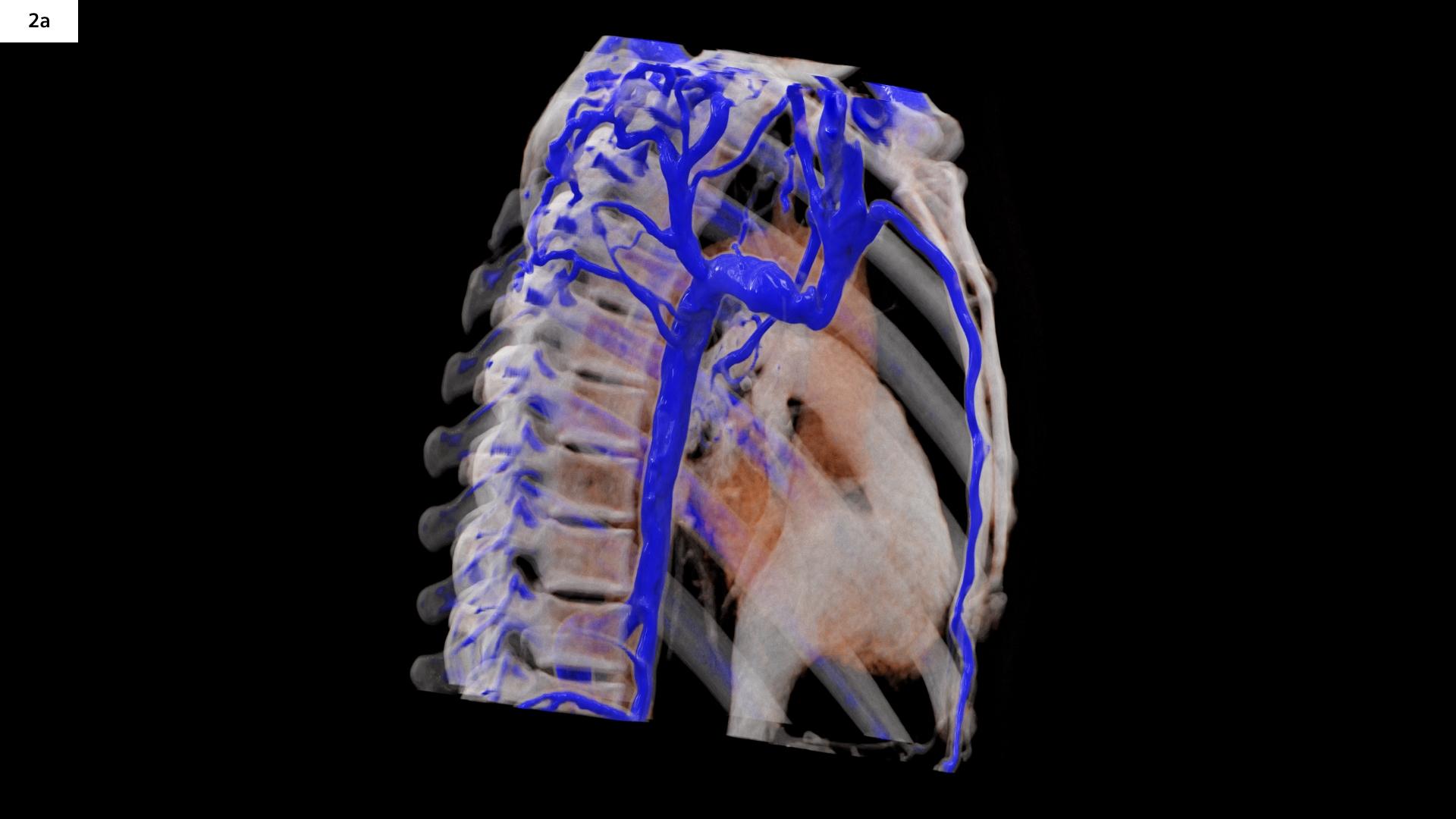 Superior vena cava obstruction caused by a primary mediastinal large B ...