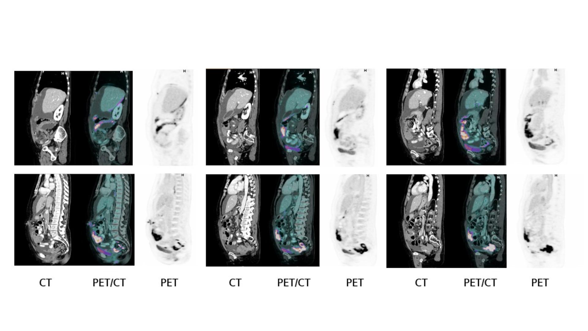 18F-FDG delineation of peritoneal carcinomatosis in ovarian carcinoma