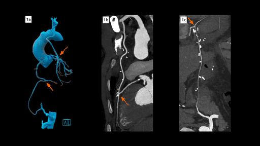 CABG of the right gastroepiploic artery and of the left internal ...
