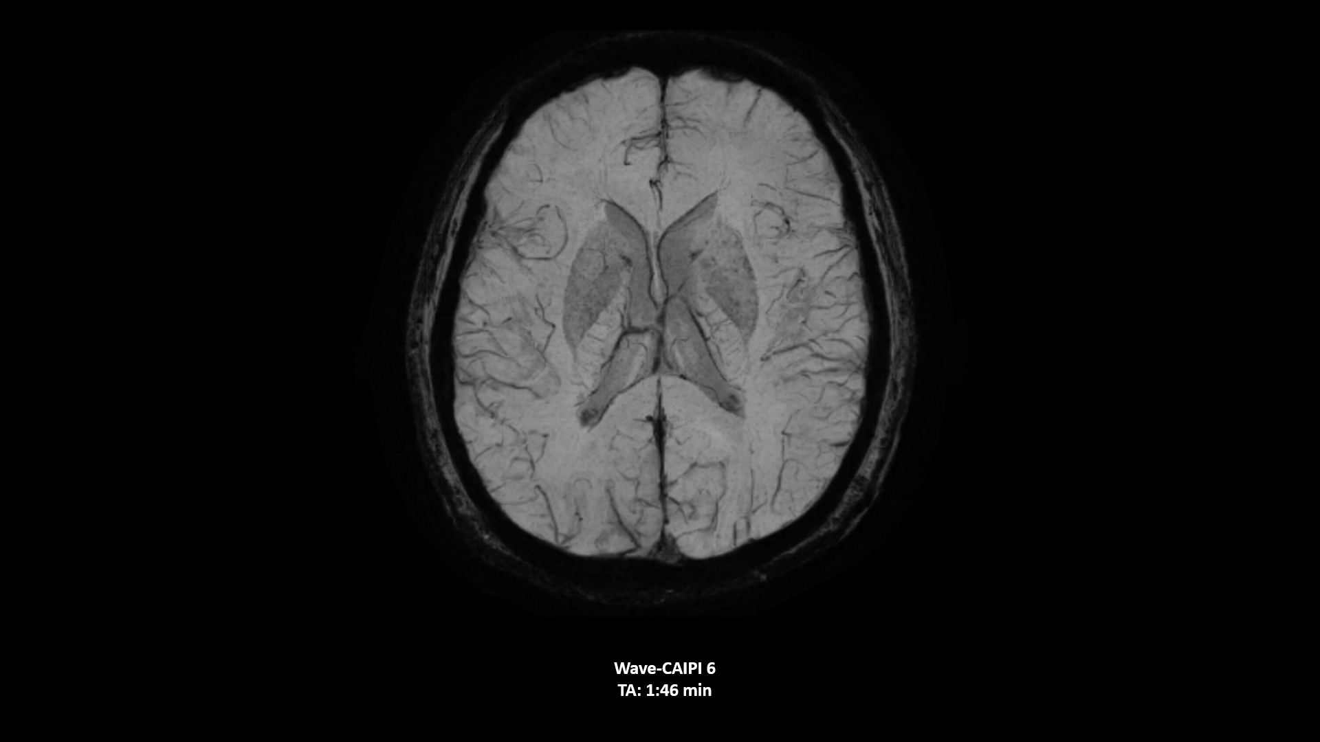 Wave-CAIPI SWI - Siemens Healthineers USA