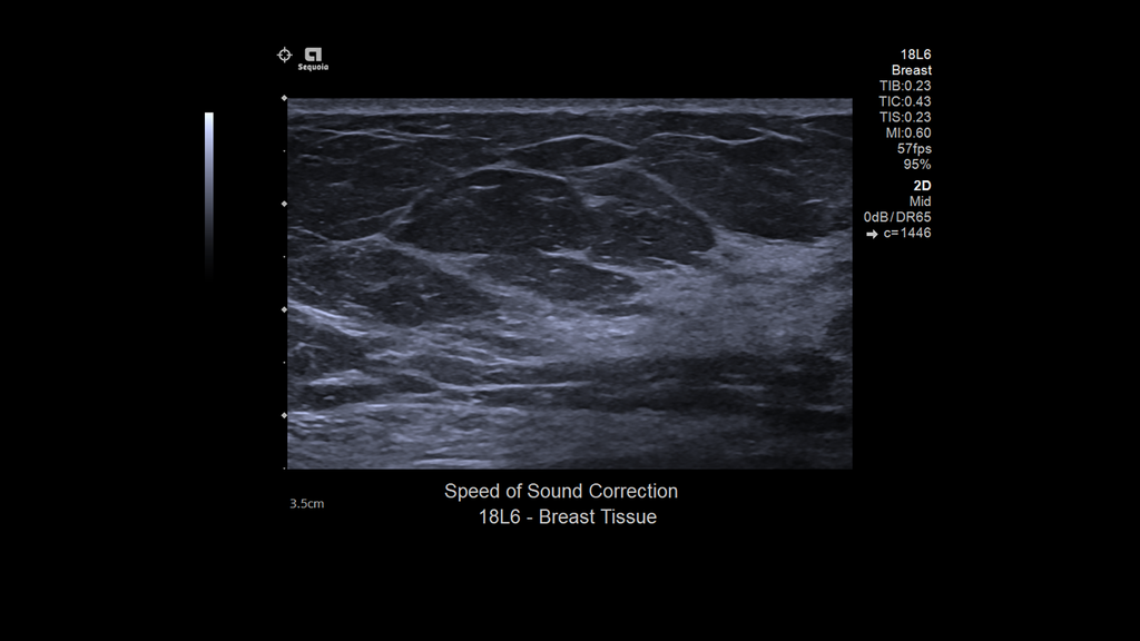 ACUSON Sequoia Ultrasound System - Siemens Healthineers