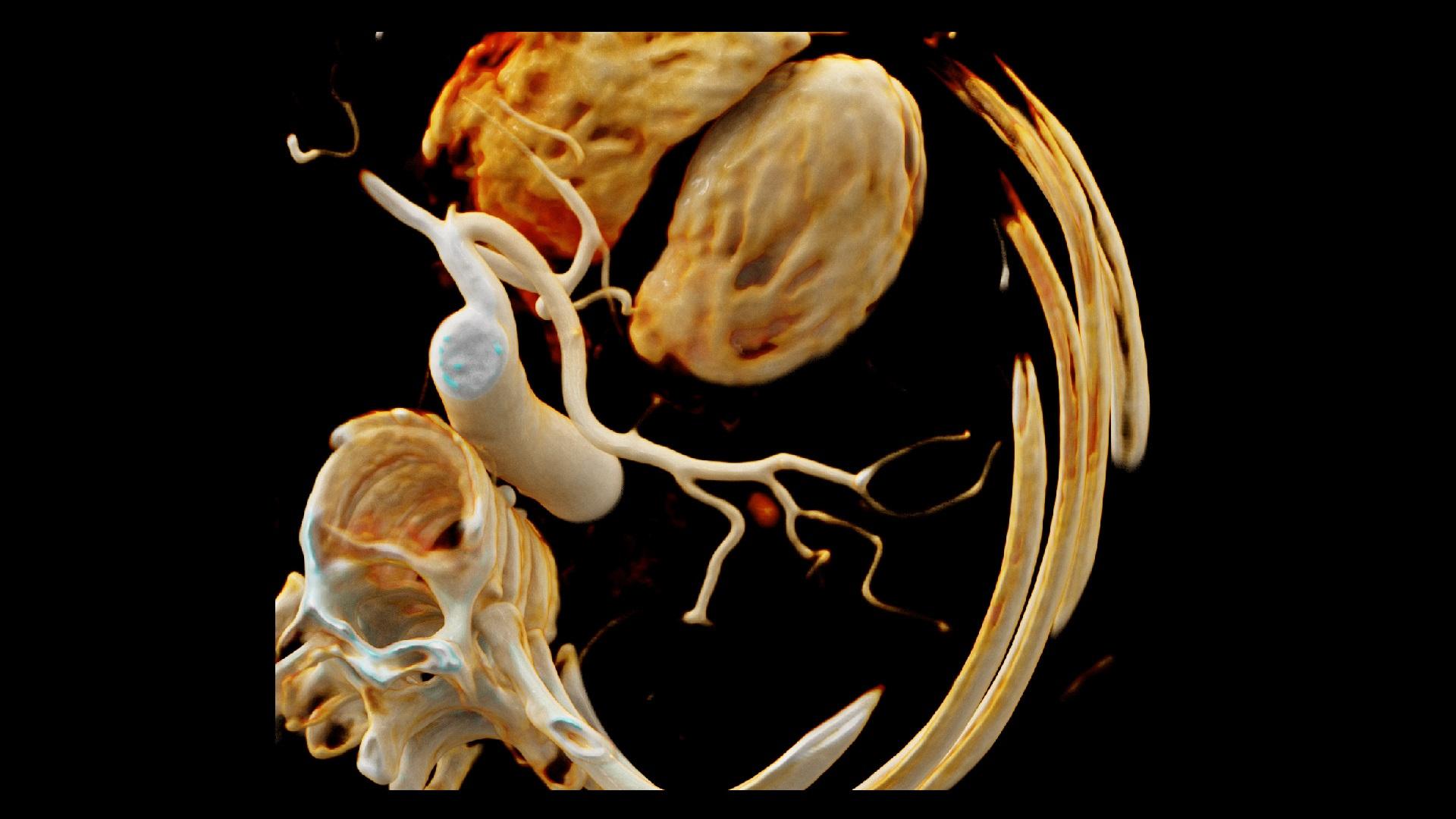 Multiple gastrinomas - Siemens Healthineers USA