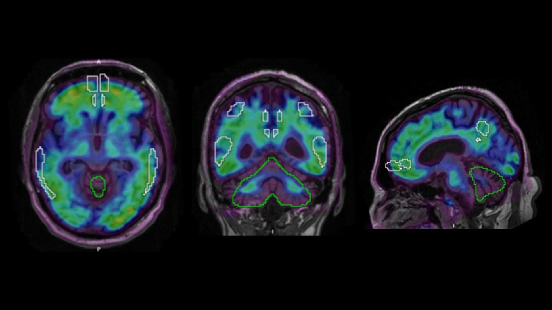 Beta-amyloid PET/CT imaging in the assessment of memory loss and ... Beta-amyloid PET/CT imaging in the assessment of memory loss and ...