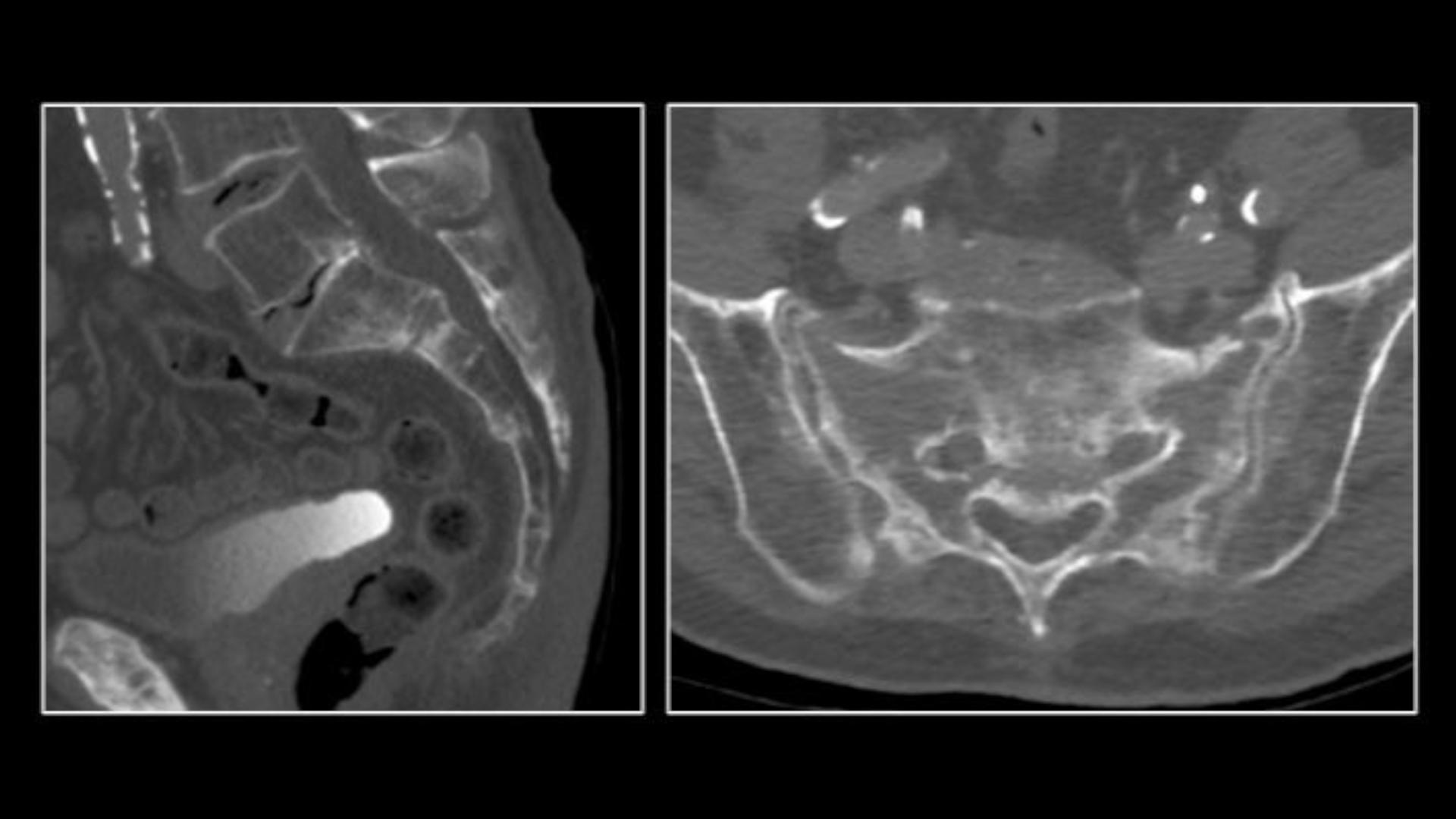 Interventional Oncology Procedures - Siemens Healthineers