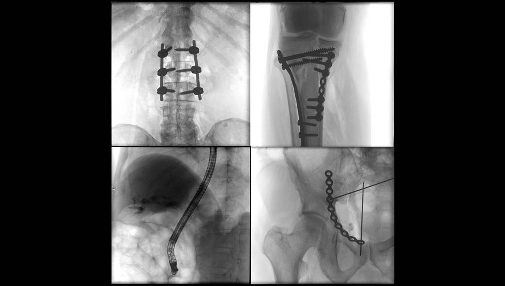 Mobile c-arm machine - Cios Flow - Siemens Healthineers