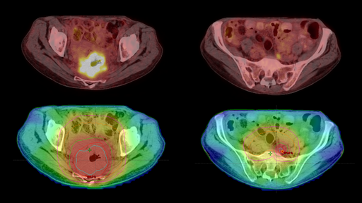 Biograph mCT PET/CT scanner - Siemens Healthineers USA