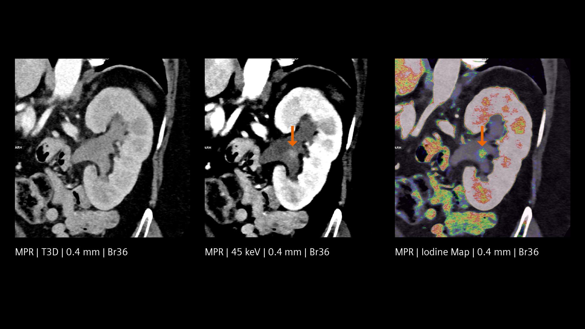 PCCT oncology imaging - Siemens Healthineers