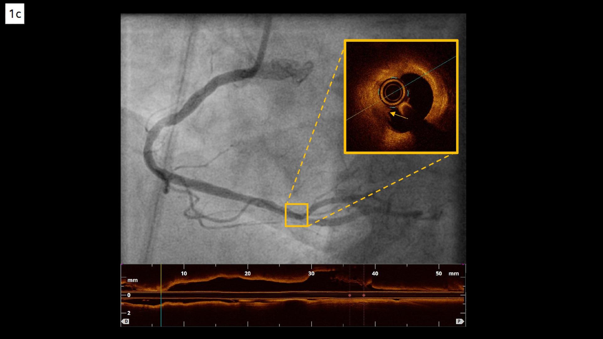 Beneath the calcified plaque in the distal right coronary artery ...