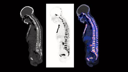 Fast, quantitative SPECT/CT acquisition following multiple therapy ...