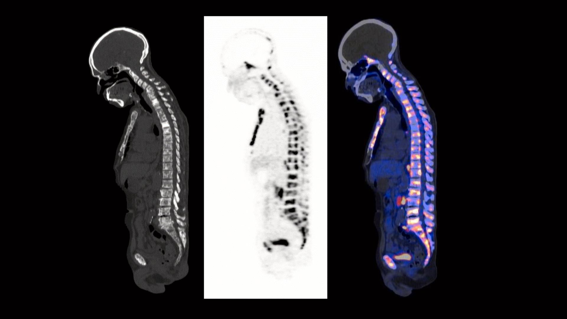 Fast, quantitative SPECT/CT acquisition following multiple therapy ...