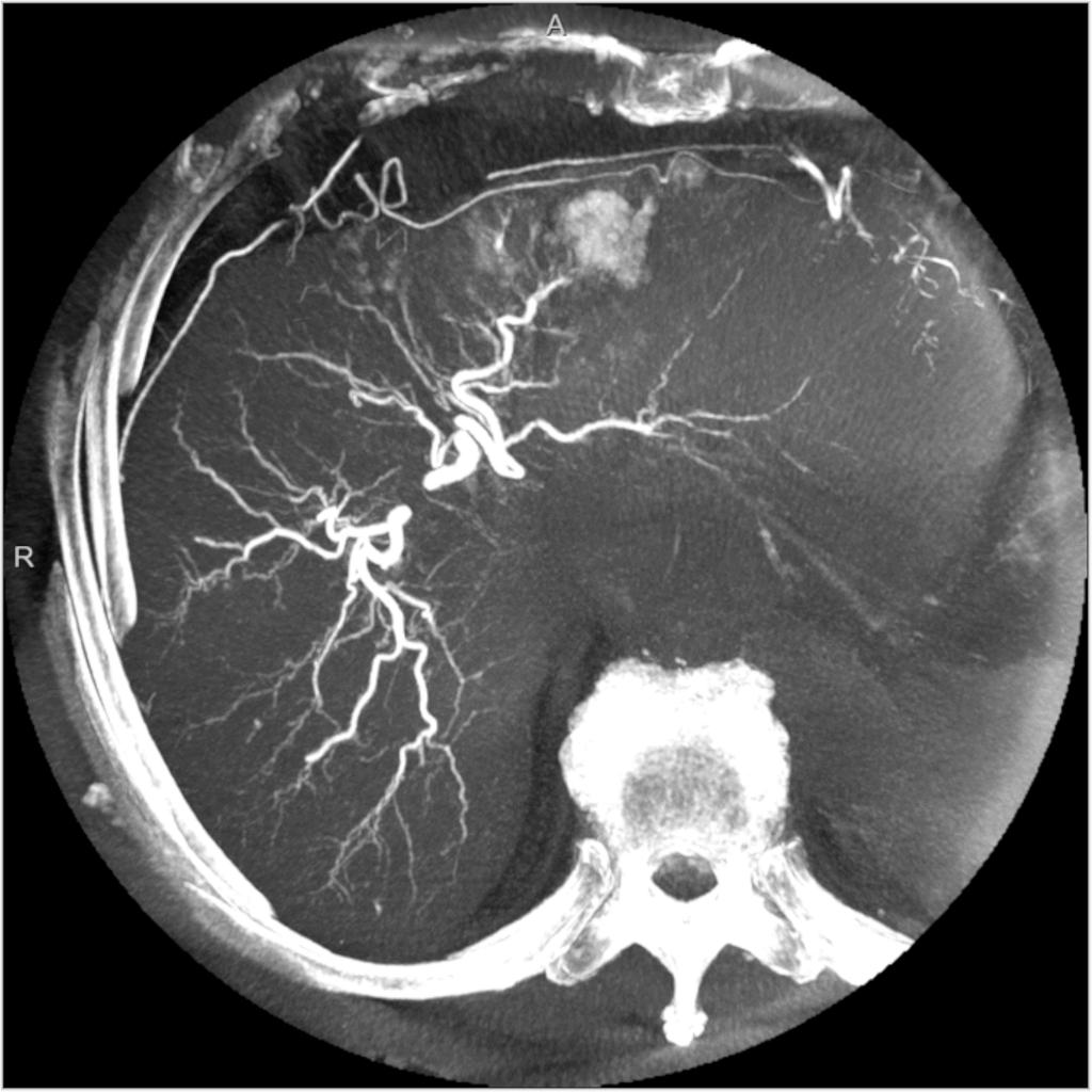 Interventional Oncology Procedures - Siemens Healthineers