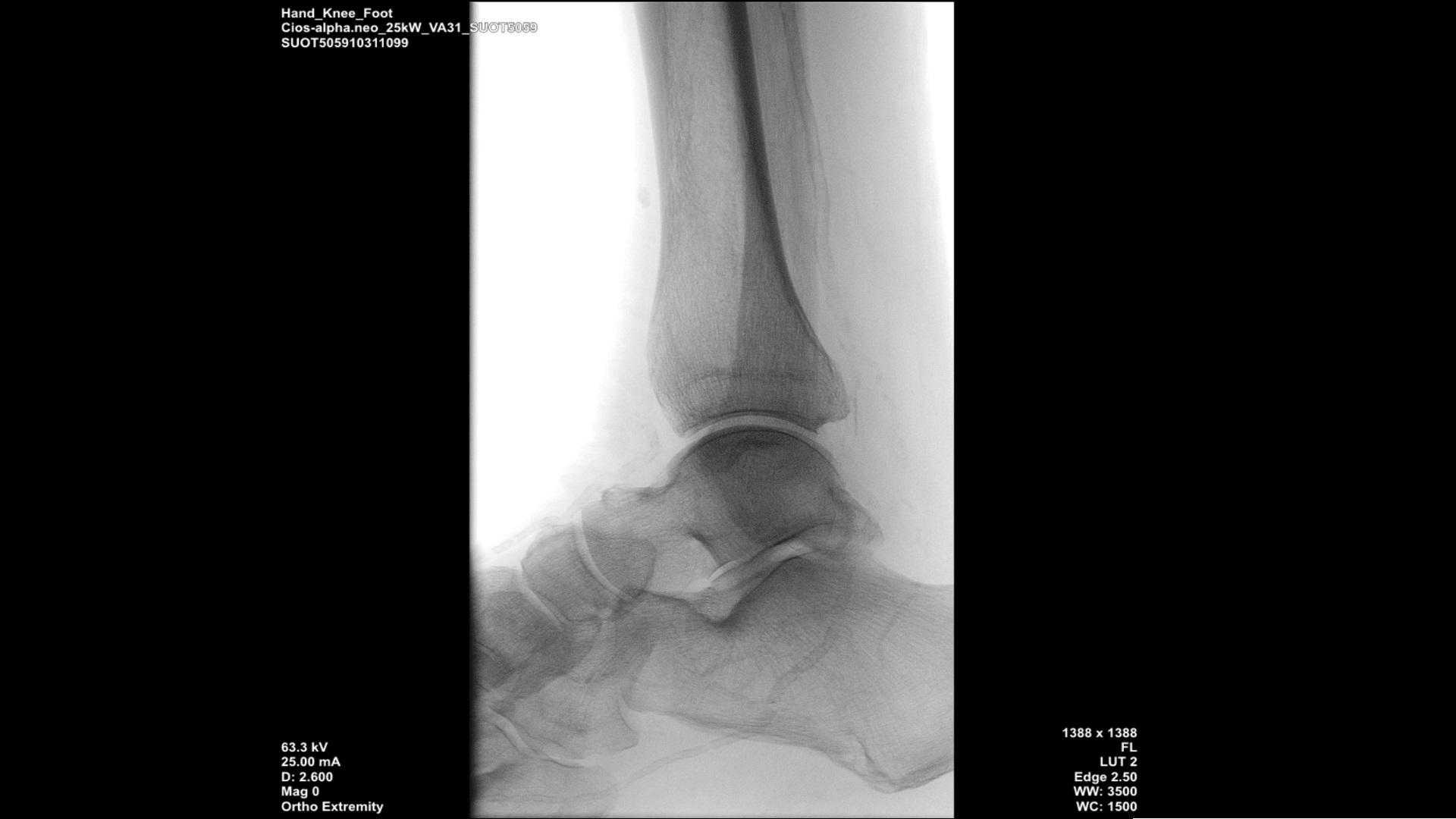 Cios Alpha.neo – Mobile C-arm machine