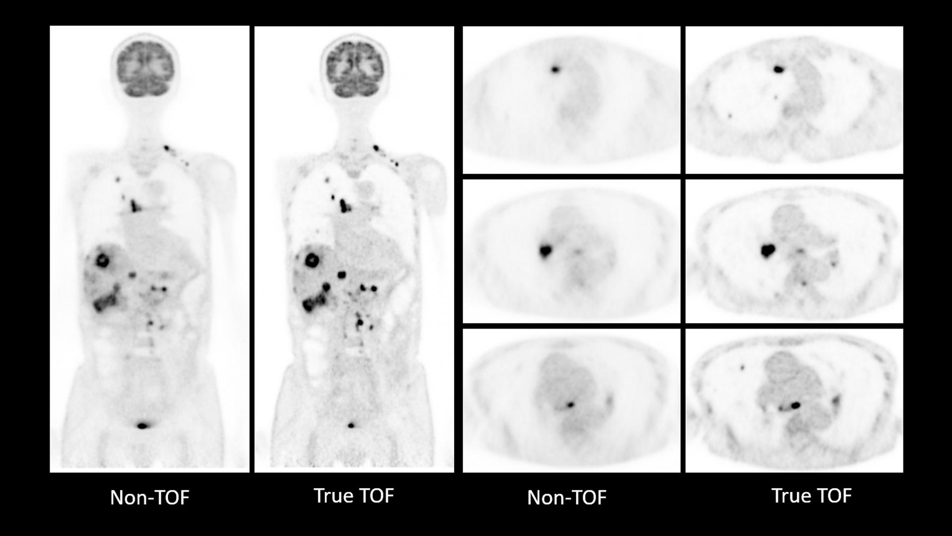 True TOF technology - Siemens Healthineers