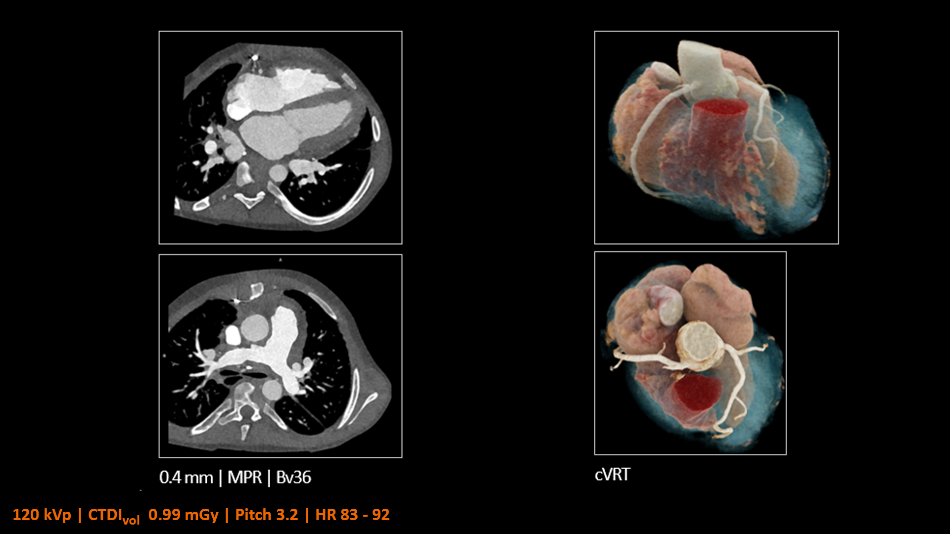 Dual Source CT - Siemens Healthineers