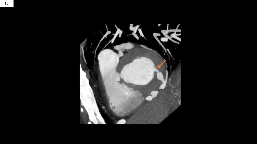 Coronary Cameral Fistula - Siemens Healthineers USA