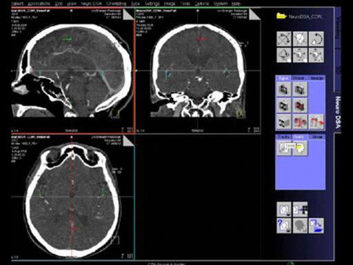 syngo Neuro DSA CT - Siemens Healthineers Polska