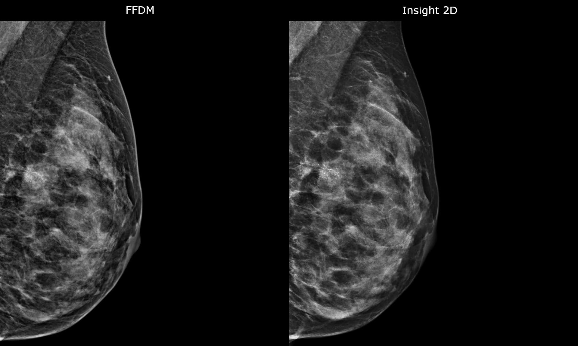Breast Cancer Imaging at St. Anna, Luzern - Siemens Healthineers