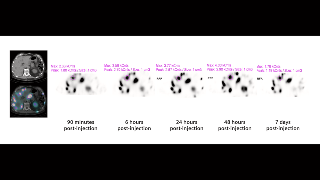 Tumor & Organ Dosimetry From Sequential Quantitative SPECT/CT - Siemens ...