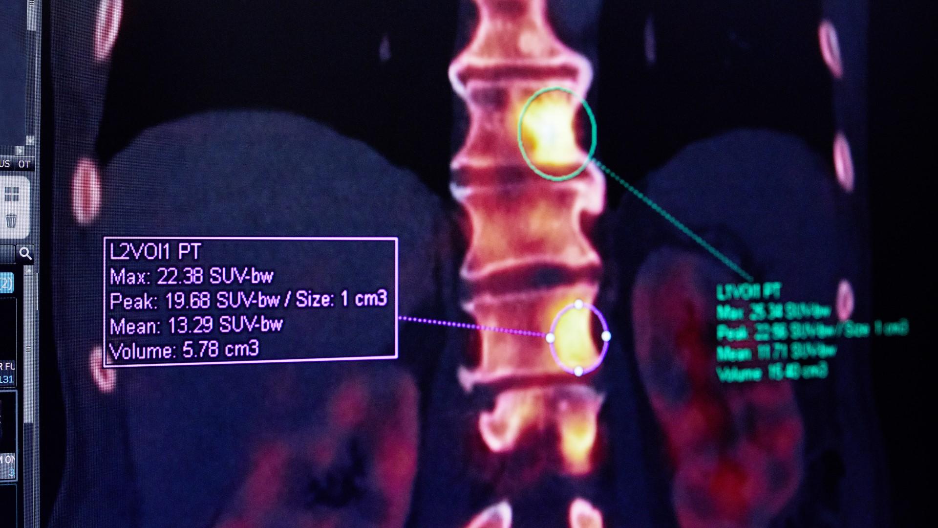 SPECT/CT Provides One-Stop Imaging - Siemens Healthineers