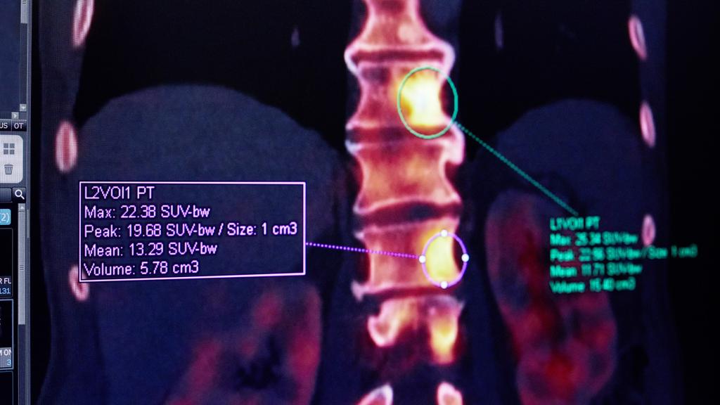 SPECT/CT Provides One-Stop Imaging - Siemens Healthineers