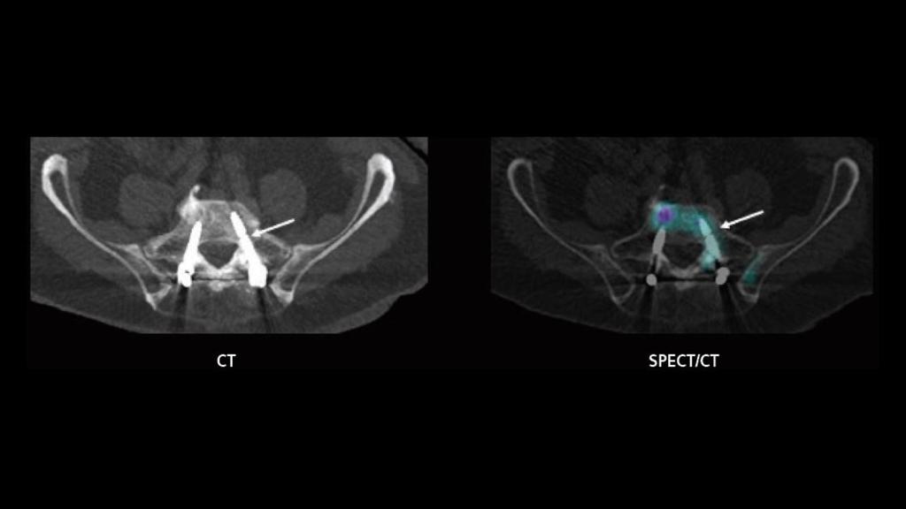 SPECT/CT imaging in the evaluation of pain following spinal fusion ...