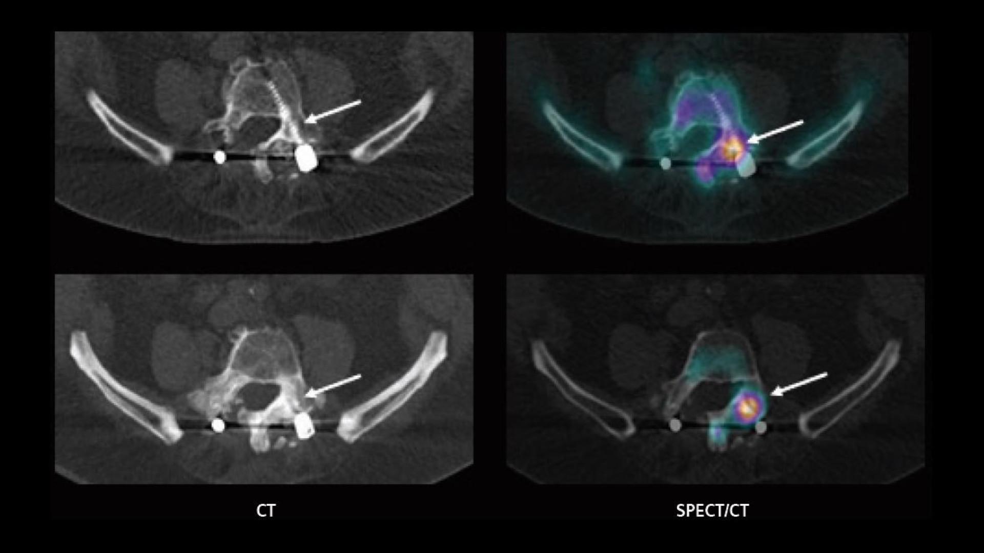 SPECT/CT imaging in the evaluation of pain following spinal fusion ...