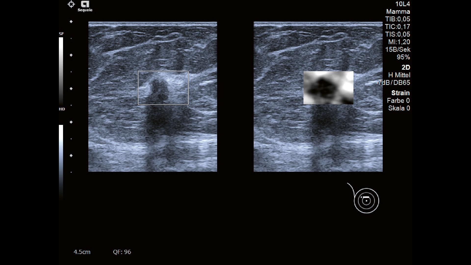 Casos prácticos de ultrasonido de mama - Siemens Healthineers Latinoamérica