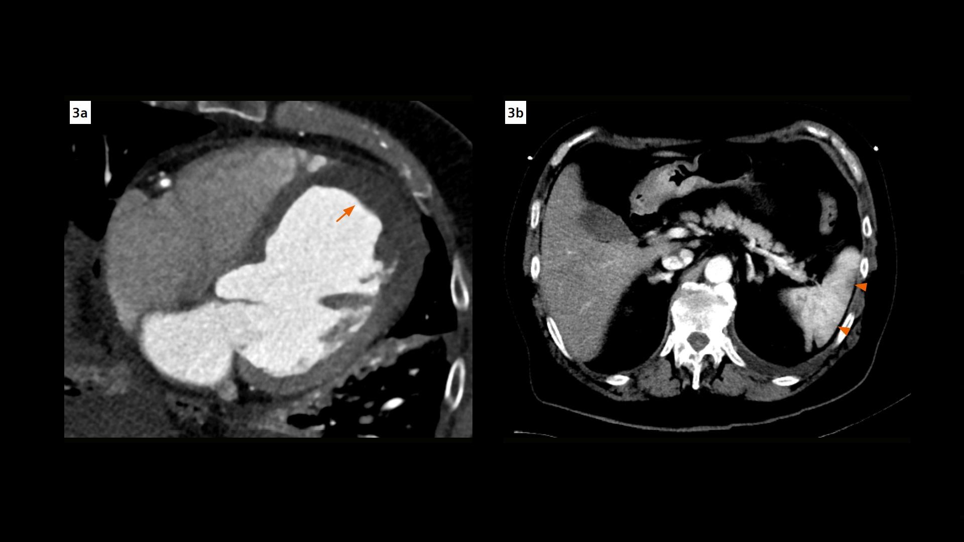 LAD occlusion – acute or chronic?