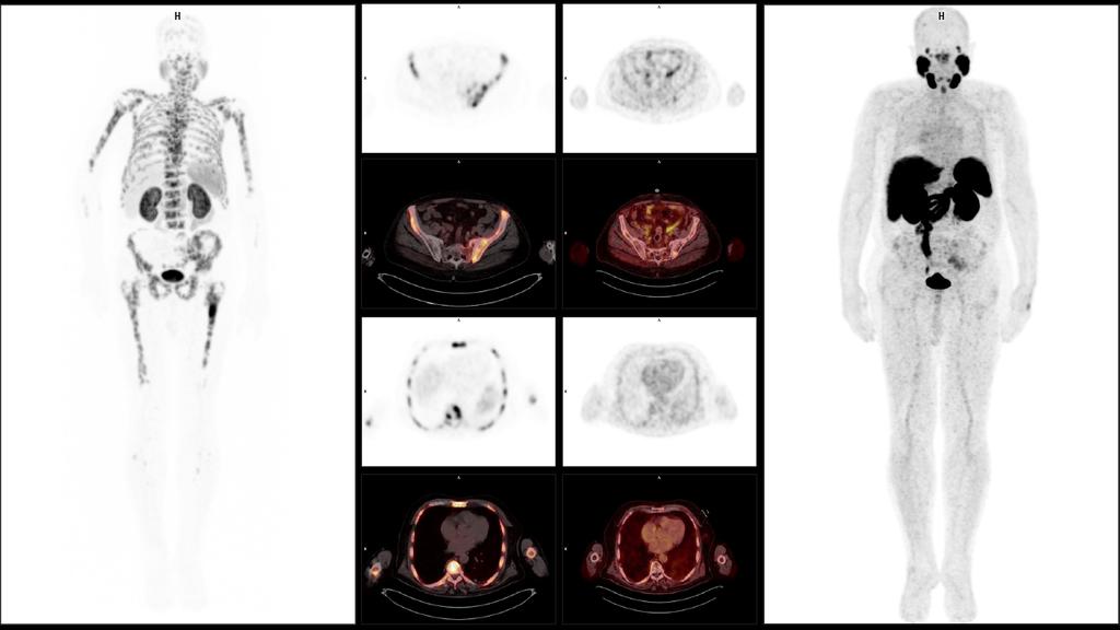 Theranostics by Nuclear Medicine Technology is a new hope for Prostate ...