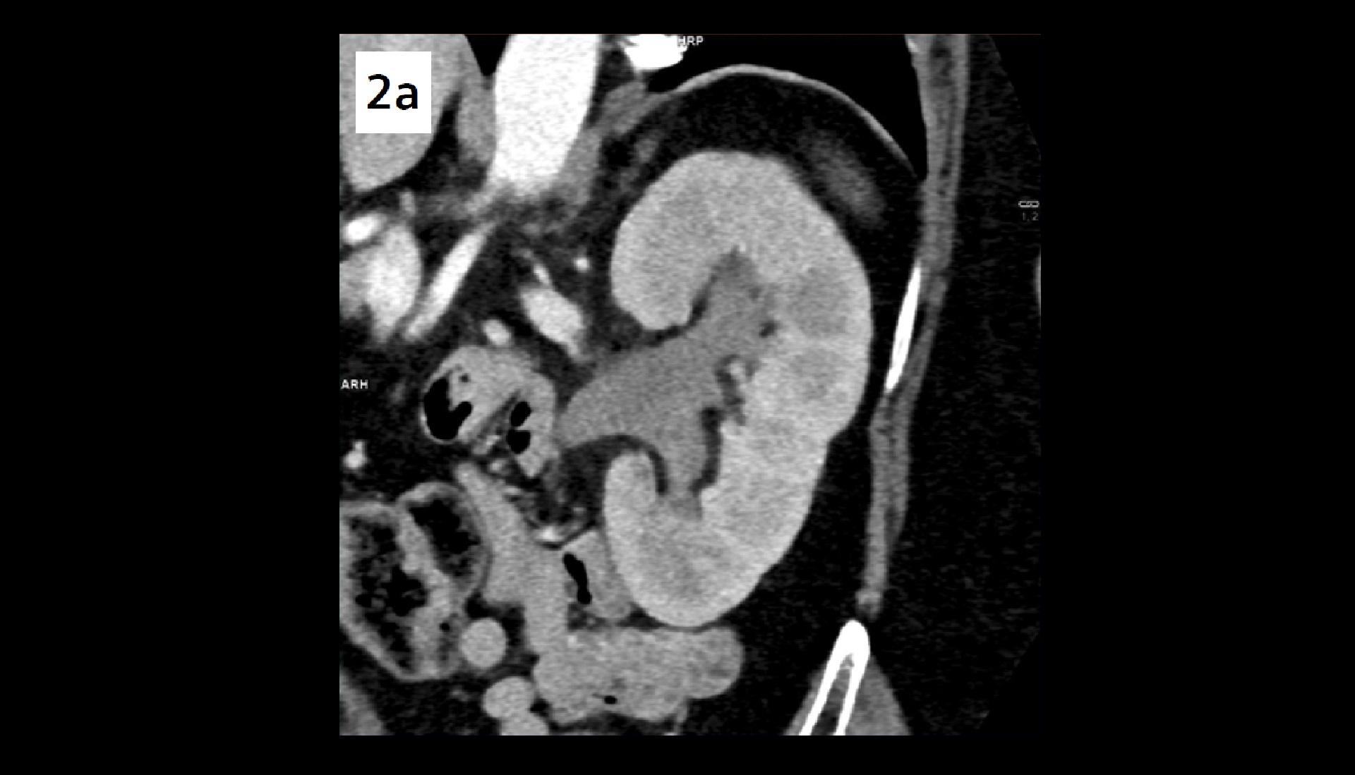 Severe Ureteral Obstruction Secondary to an Upper Urinary Tract ...